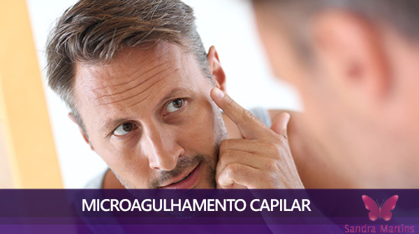 microagulhamento-capilar-em-brasilia-studio-sandra-martins - Sandra ...