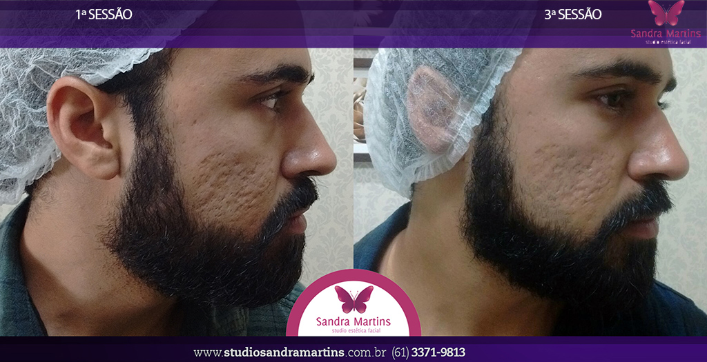 microagulhamento-antes-e-depois-brasilia-cicatriz-de-acne-df - Sandra ...