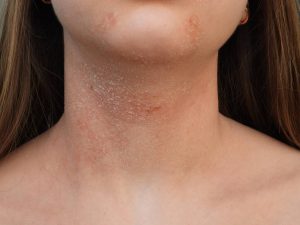 O que é Xerose? Sintomas, causas e soluções para pele seca em Brasília