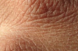 O que é Xerose? Sintomas, causas e soluções para pele seca em Brasília