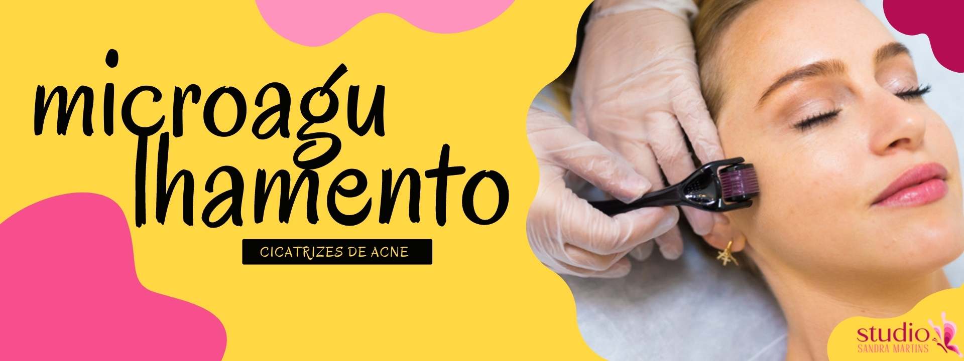 Microagulhamento em Taguatinga para cicatriz de acne