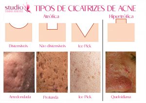 Tipos de cicatrizes de acne e o melhor tratamento em Taguatinga ...